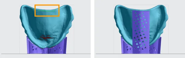 Lucitone Digital Print 3D Denture Base - Materials