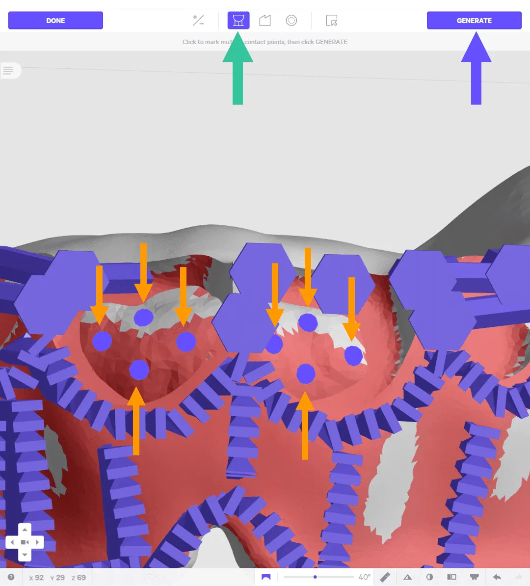 DENTCA Denture Base II for Carbon Printers - Materials
